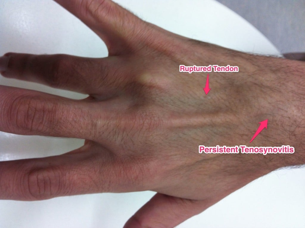 Popped Tendon In Wrist