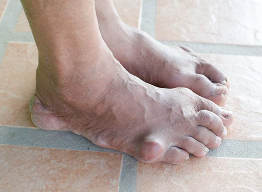 What are the Symptoms and Signs of Gout? | Gout treatment