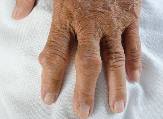 What are the Symptoms and Signs of Gout? | Gout treatment