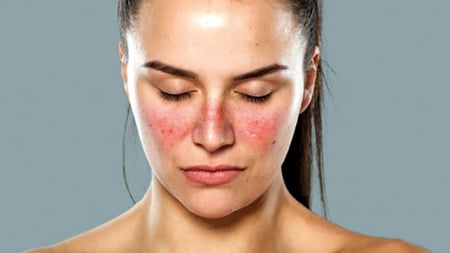 Systemic Lupus Erythematosus | Symptoms | Diagnosis | Treatment